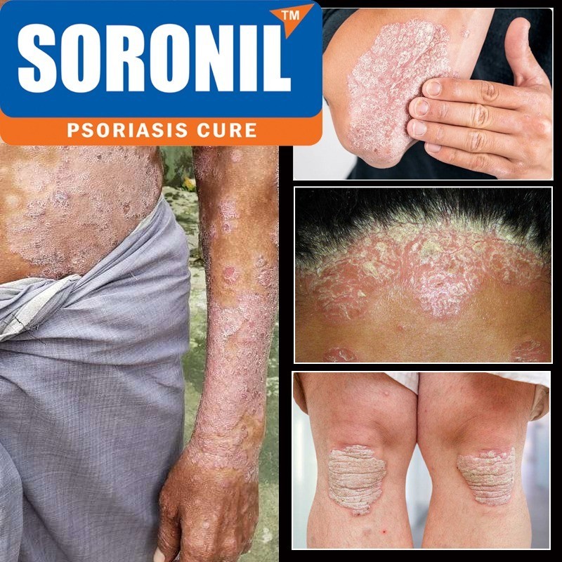 Soronil ®: Natural Herbal Remedy for Psoriasis and Other Skin Problems